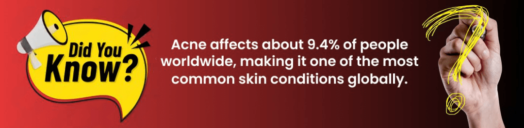 5 Benefits of Moringa for Acne Prevention and Detoxifying Skin